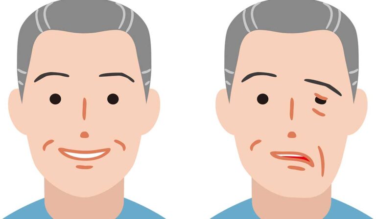 ¿CAra colgada, MAno pesada, LEngua trabada? ¡Puede ser un infarto cerebral!