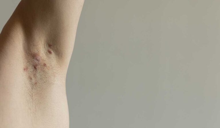 Hidradenitis supurativa o acné inverso, un mal desconocido