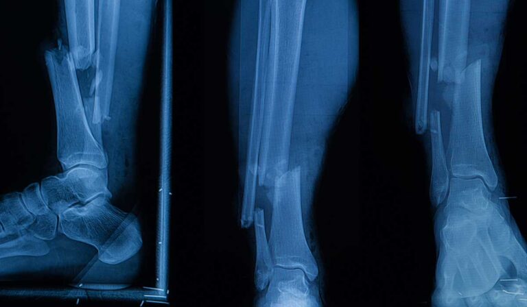 6 señales de que podrías tener osteoporosis sin saberlo 6 señales de que podrías tener osteoporosis sin saberlo
