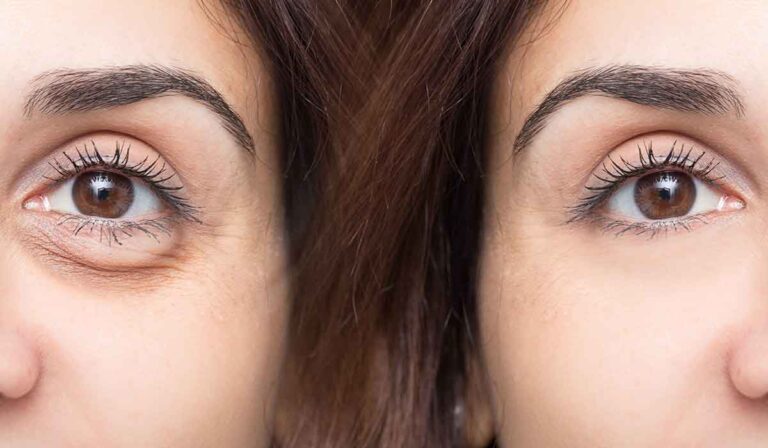 ¿Cómo tratar los ojos hinchados? Estos tips te ayudarán al instante